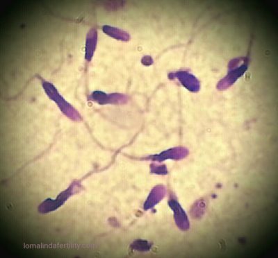 Varicoceles & Male Infertility | Loma Linda University Center for ...